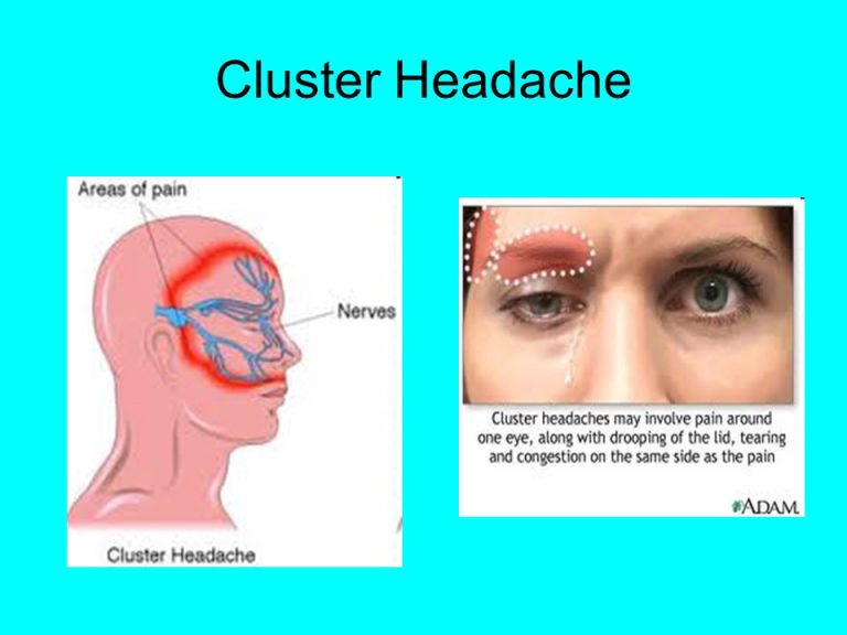 Facing Intense Headaches: How to Handle Cluster Headaches Facing Intense Headaches: How to Handle Cluster Headaches